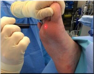 Natural Wart Removal: 6 Home Remedies That Work Fast (2026)